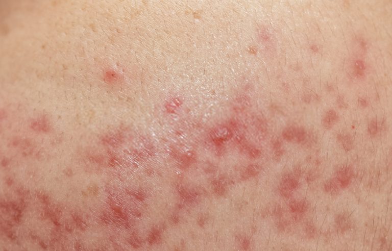 Acne Types - 05 Major Acne Types And Their Causes – DiyVines: Do It ...