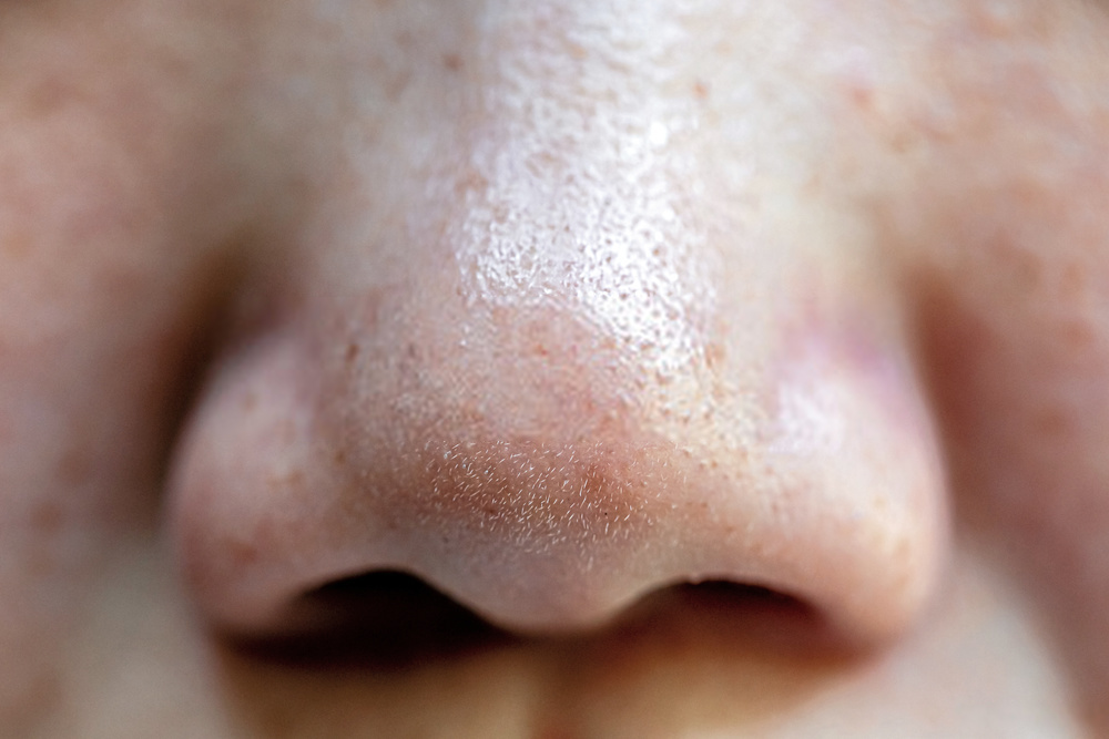 What Causes Whiteheads On The Nose 15 Remedies To Treat DiyVines